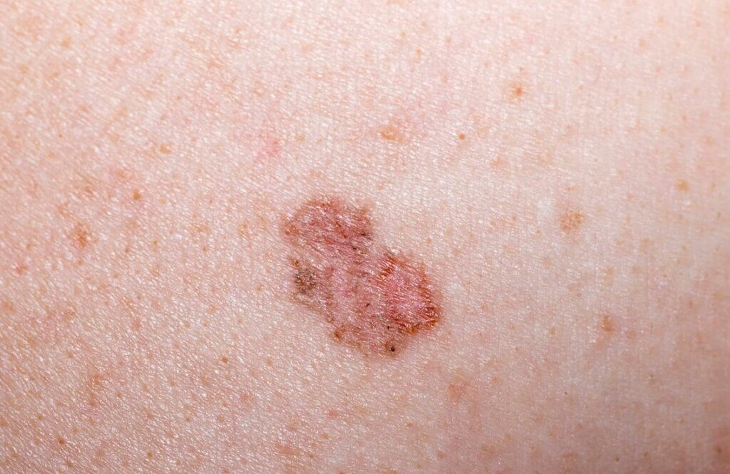 Skin marking of darkened circle - Devonshire Dermatology