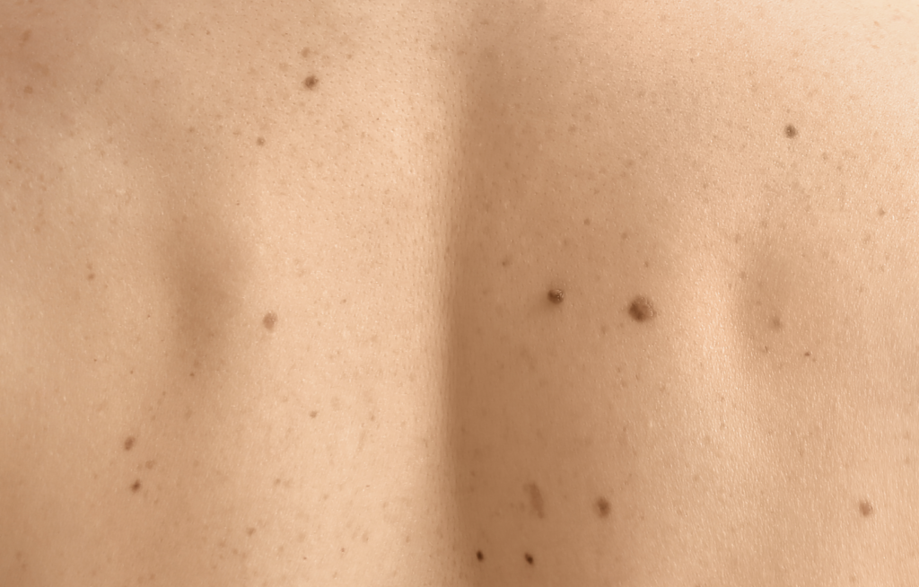 mole mapping - Devonshire Dermatology